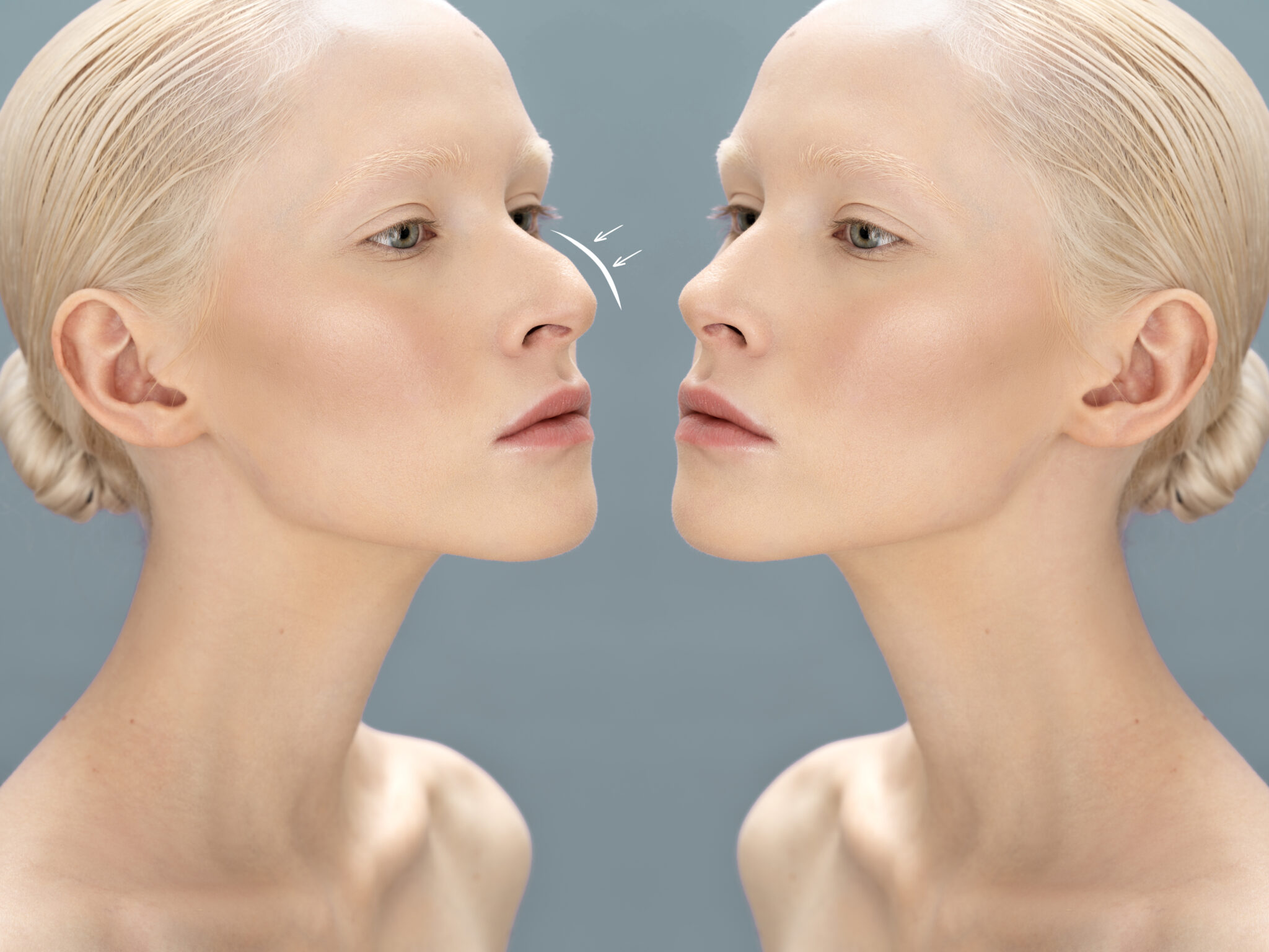 Crooked Nose: Causes, Symptoms, Treatments | Hooked Nose