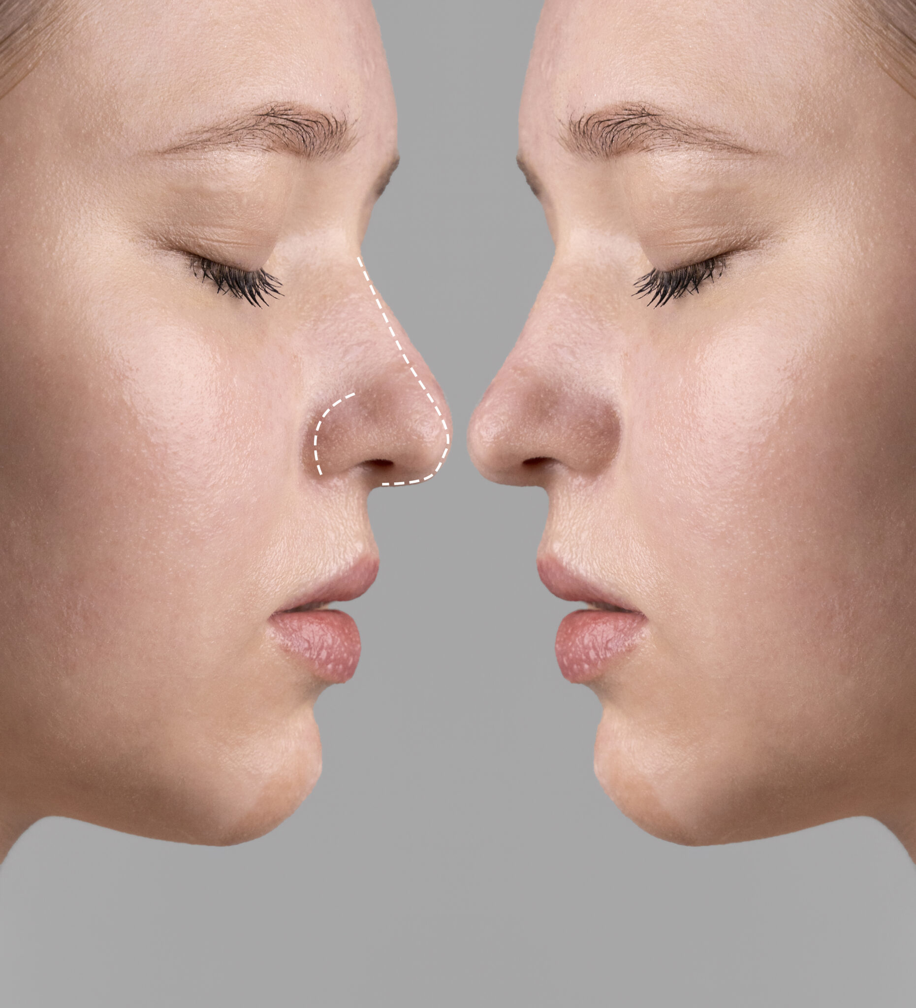 Crooked Nose: Causes, Symptoms, Treatments | Hooked Nose